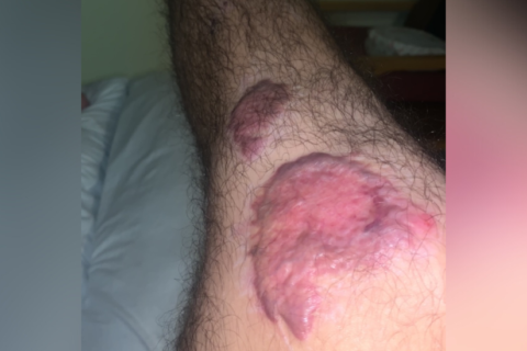 Understanding Knuckle Injuries: Signs, Symptoms, and Treatment of a ...